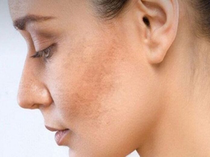 Da mặt đen làm sao để trắng? Nguyên nhân và cách thực hiện